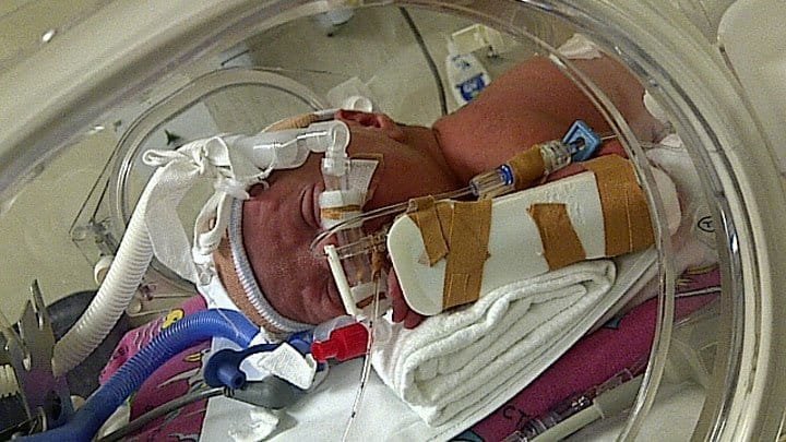 Twin to Twin Transfusion Syndrome Stories – About Twins