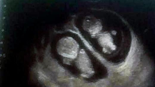 Twin Ultrasound 12 Weeks: Dating & Chorionicity Scan – About Twins