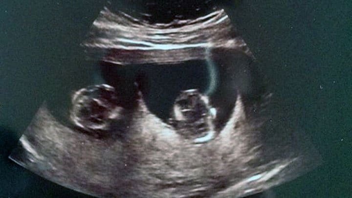 Twin Ultrasound 12 Weeks: Dating & Chorionicity Scan – About Twins