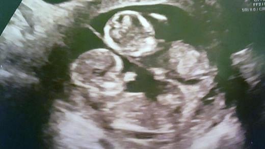 Twin Ultrasound 12 Weeks: Dating & Chorionicity Scan – About Twins
