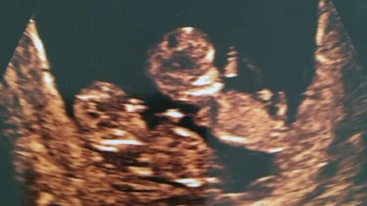 Twin Ultrasound 12 Weeks: Dating & Chorionicity Scan – About Twins