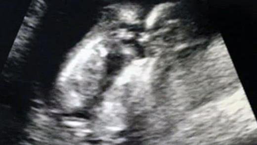 Twin Ultrasound 12 Weeks: Dating & Chorionicity Scan – About Twins