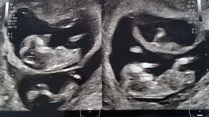 12 Weeks Pregnant With Twins: Belly, Symptoms & Ultrasound Pictures ...