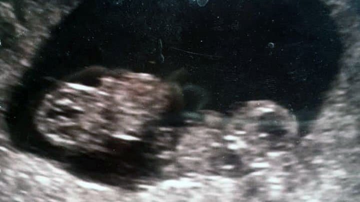 9 Weeks Pregnant With Twins: Ultrasound, Symptoms & Physical Acticity ...